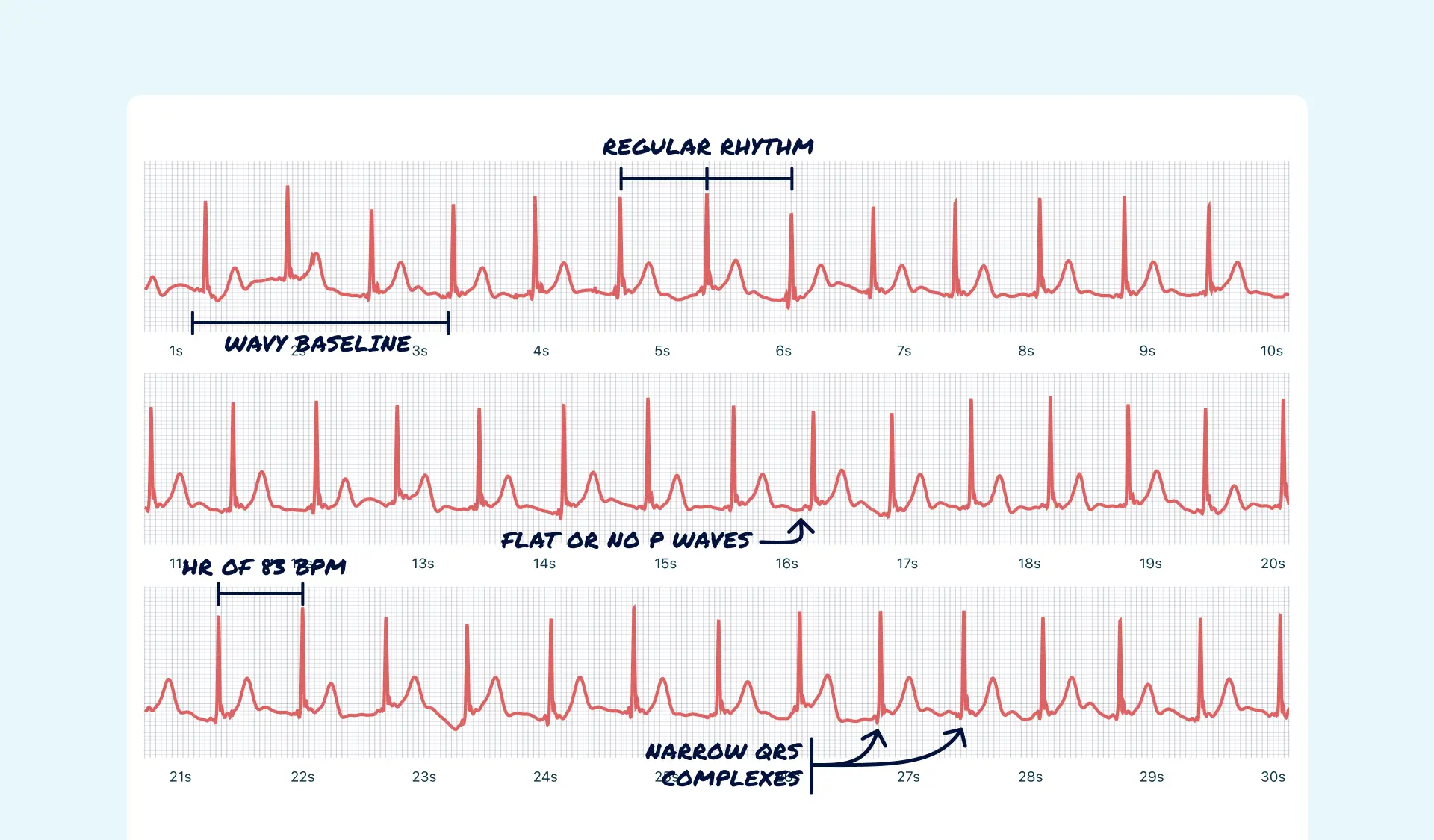 Junctional Rhythm Vs. Sinus Rhythm on Your Watch ECG | Qaly